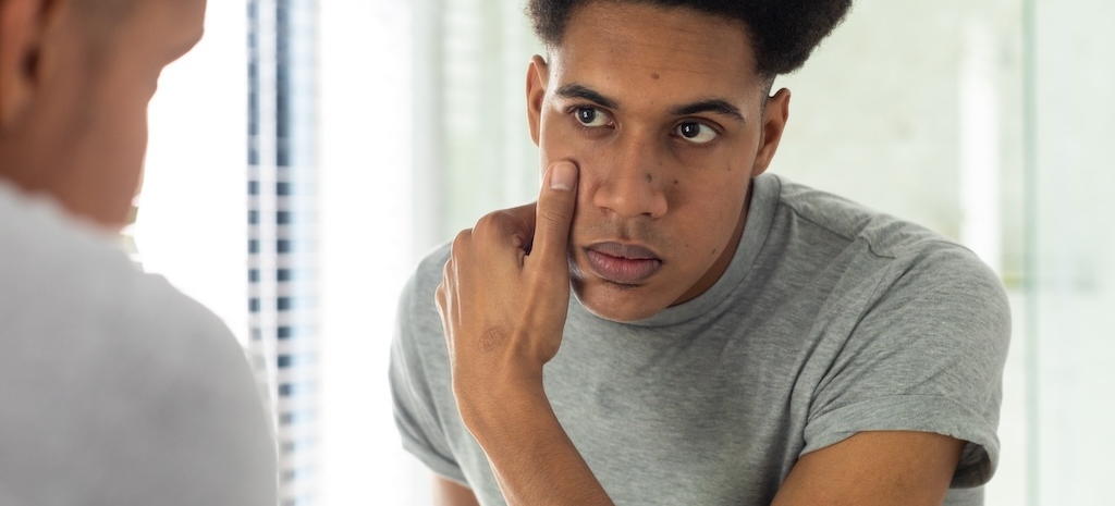 Meth Sores: Causes, Treatment & Recovery | What Are Meth Sores?