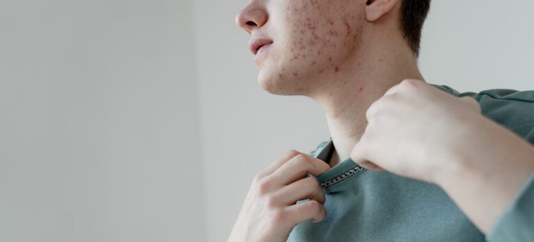 Meth Sores: Causes, Treatment & Recovery | What Are Meth Sores?