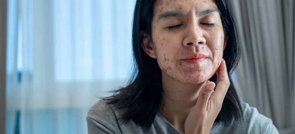 Meth Sores: Causes, Treatment & Recovery | What Are Meth Sores?